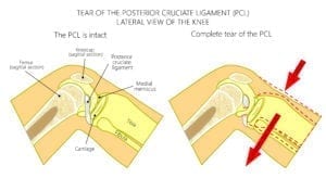 Posterior Cruciate Ligament (PCL) Tears - Upswing Health | Upswing Health