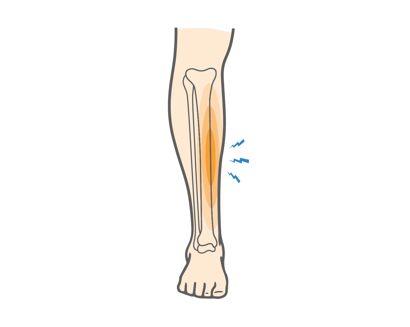 What Are Shin Splints How To Treat Lower Leg Pain Upswing Health
