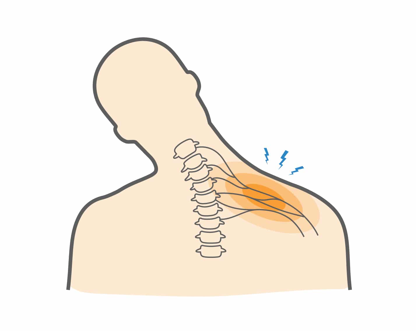 What Is A Stinger How To Deal With Nerve Related Pain Upswing Health What Is A Stinger How To Deal With Nerve Related Pain Upswing Health