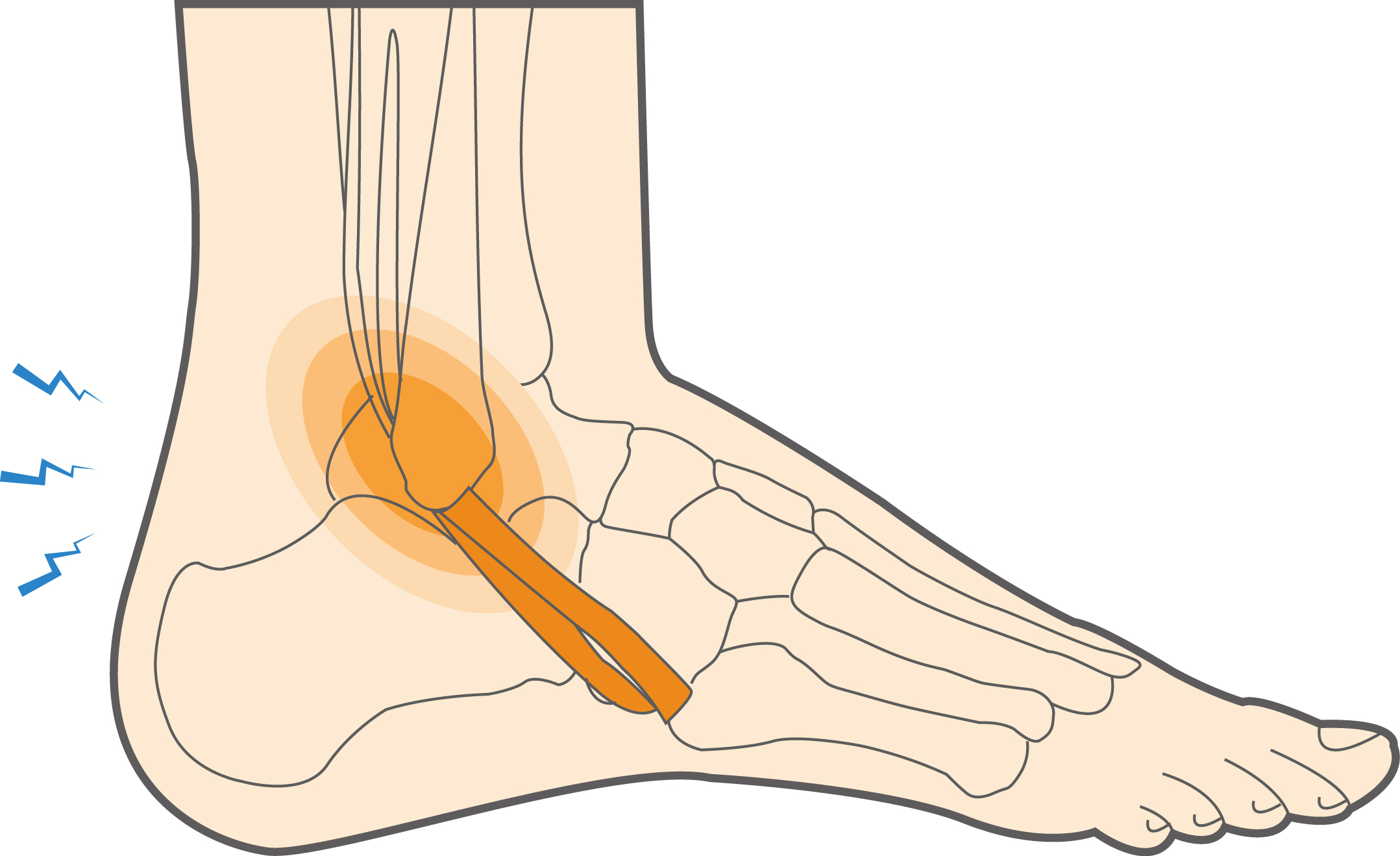 What Is Peroneal Tendonitis How To Manage Foot Pain 43 OFF